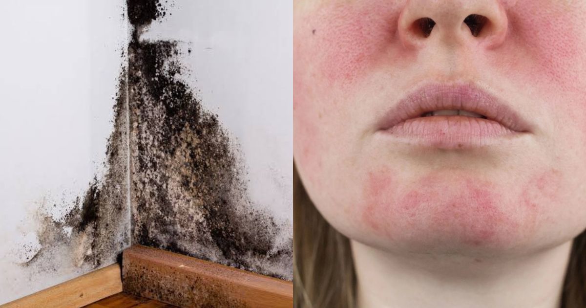 UK Woman Reveals How a Mould Infection in the House ‘blew up’ Her Face ...