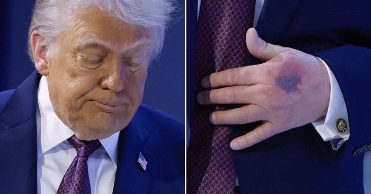 Doctor Says Trump’s Story Behind Fresh Bruises on His Hands ‘Makes No ...