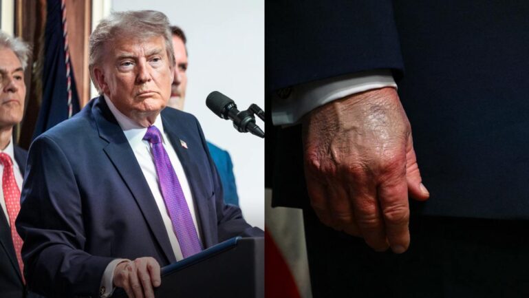 Trump's Bruised Hand at White House Health Event Sparks Concerns ...